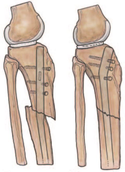 Question 5618 - Qbank - Orthobullets