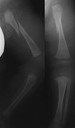Hip Septic Arthritis - Pediatric - Pediatrics - Orthobullets