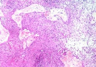Osteomyelitis - Pediatric - Pediatrics - Orthobullets