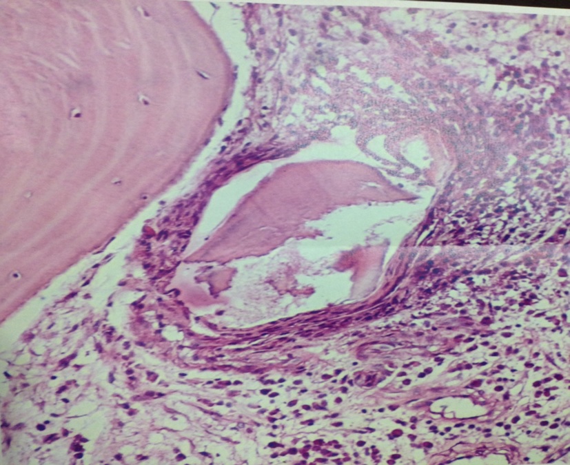 Osteomyelitis - Pediatric - Pediatrics - Orthobullets
