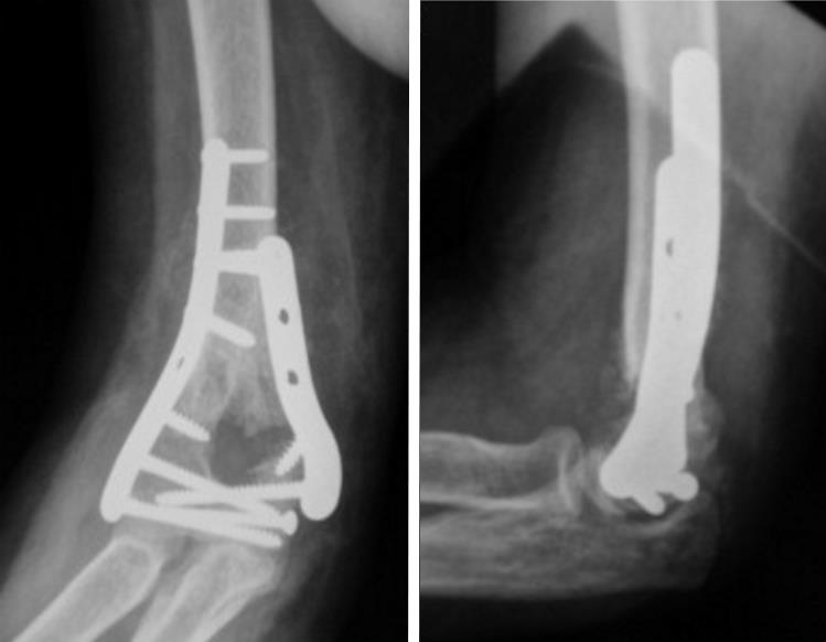 Question 5691 - Qbank - Orthobullets