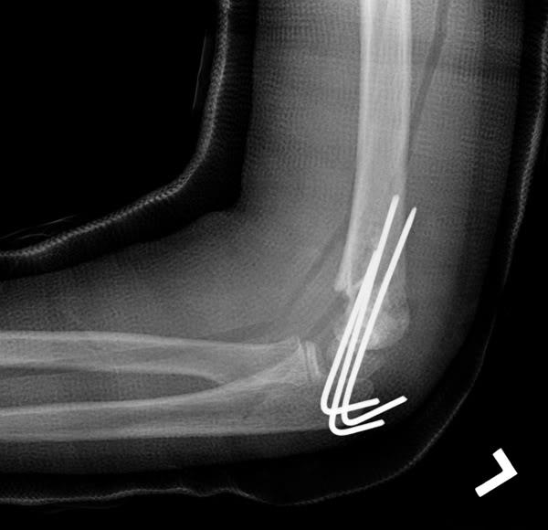 Question 5695 - Qbank - Orthobullets