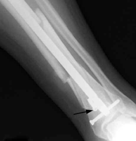 Question 5725 - Qbank - Orthobullets