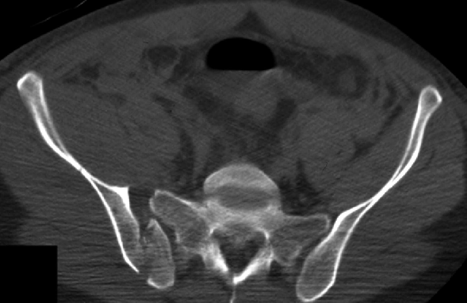 Pelvic Ring Fractures - Trauma - Orthobullets