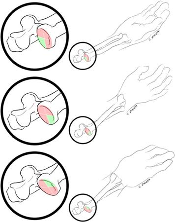 Question 578 - Qbank - Orthobullets