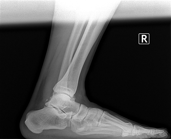 Tibiotalar Impingement - Foot & Ankle - Orthobullets