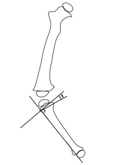 Question 218231 - Qbank - Orthobullets