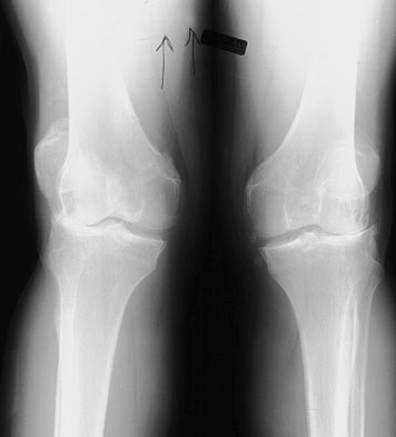 High Tibial Osteotomy - Recon - Orthobullets
