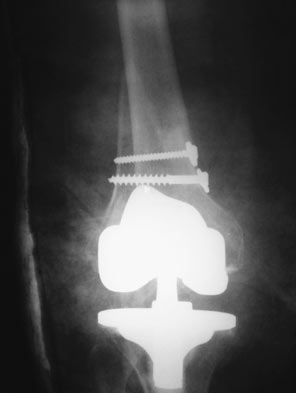 TKA Periprosthetic Fracture - Recon - Orthobullets