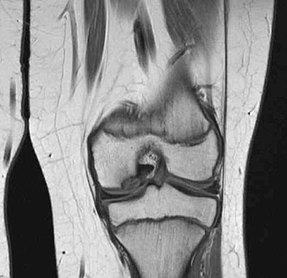 Osteonecrosis of the Knee - Knee & Sports - Orthobullets