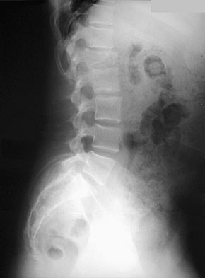 Thoracolumbar Burst Fractures - Spine - Orthobullets