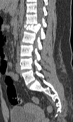 Thoracolumbar Burst Fractures - Spine - Orthobullets