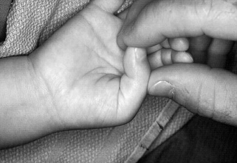 Congenital Trigger Thumb - Hand - Orthobullets