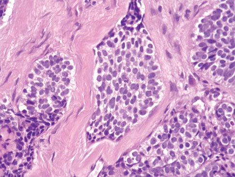 Adamantinoma - Pathology - Orthobullets