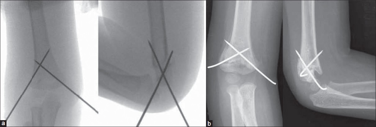 Supracondylar Fracture - Pediatric - Pediatrics - Orthobullets