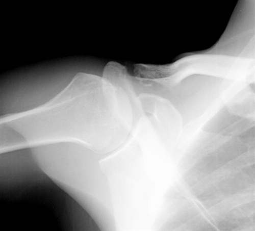 Distal Clavicle Osteolysis - Shoulder & Elbow - Orthobullets