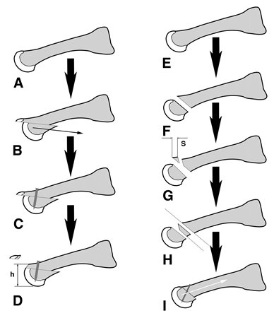 Claw Toe - Foot & Ankle - Orthobullets