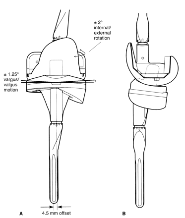 TKA Prosthesis Design - Recon - Orthobullets
