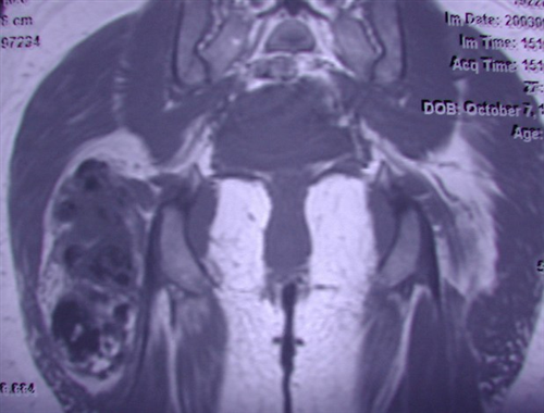 Tumoral Calcinosis - Pathology - Orthobullets
