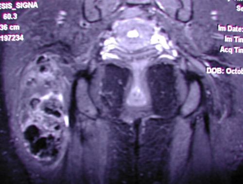 Tumoral Calcinosis - Pathology - Orthobullets