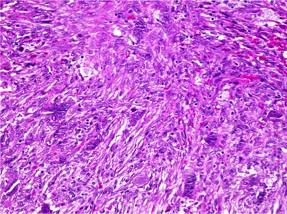 Non-ossifying Fibroma - Pathology - Orthobullets