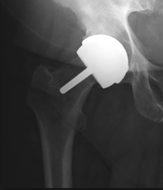 Hip Resurfacing - Recon - Orthobullets