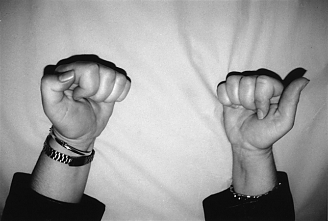 AIN Compressive Neuropathy - Hand - Orthobullets