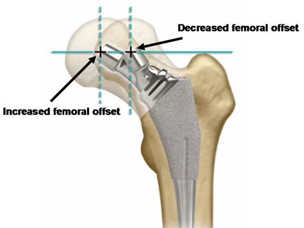 THA Stability Techniques - Recon - Orthobullets