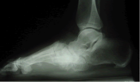 Diabetic Charcot Neuropathy - Foot & Ankle - Orthobullets