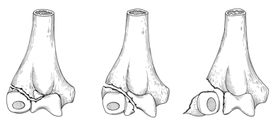 Lateral Condyle Fracture - Pediatric - Pediatrics - Orthobullets