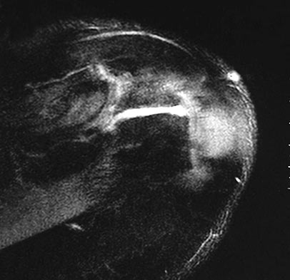 Os Acromiale - Shoulder & Elbow - Orthobullets