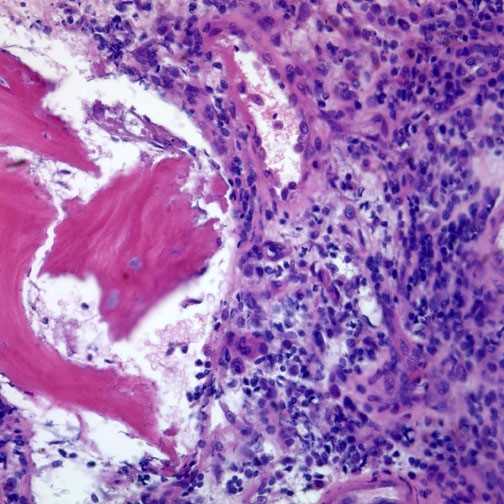 Osteomyelitis - Pediatric - Pediatrics - Orthobullets