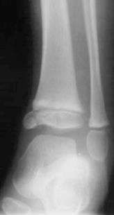Injuries of the epiphyseal plate. - Post - Orthobullets