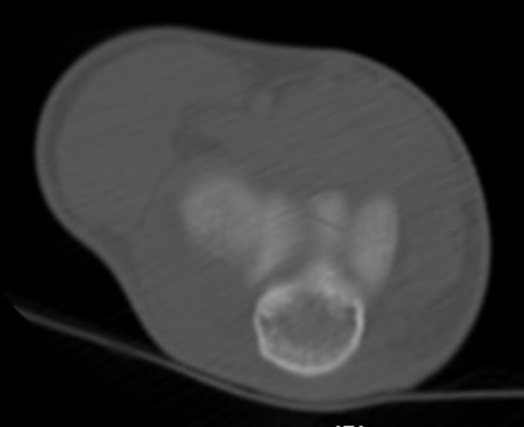 Question 9113 - Qbank - Orthobullets