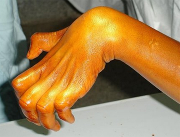 Intrinsic Minus Hand (Claw Hand) - Hand - Orthobullets