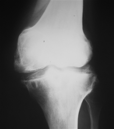 Diabetic Charcot Neuropathy - Foot & Ankle - Orthobullets