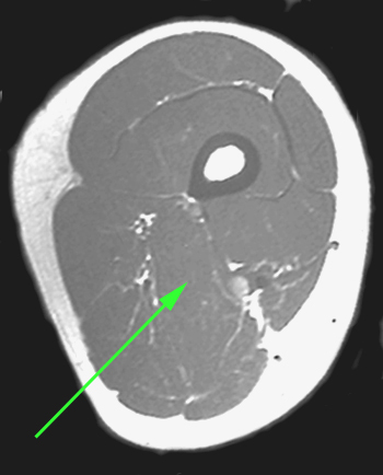 Adductor magnus - Anatomy - Orthobullets.com