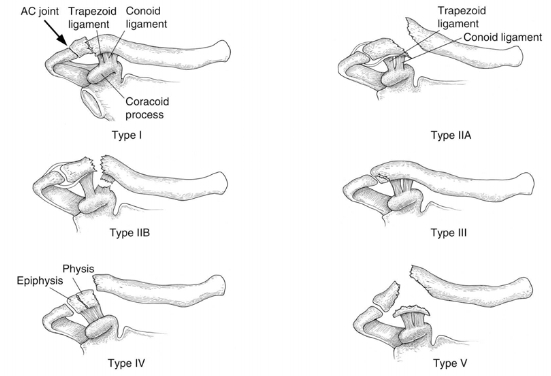 Clavicle Fracture Classification Upper Limb Injuries | Emergency Care