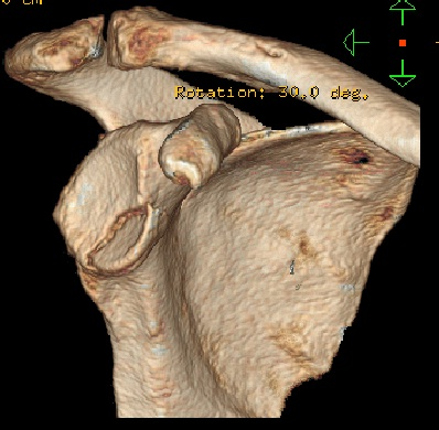 Scapula Fractures - Trauma - Orthobullets