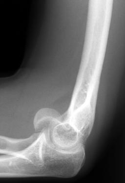 Capitellum Fractures - Trauma - Orthobullets