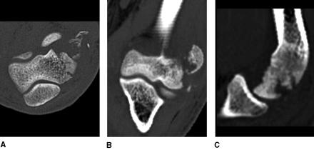 Capitellum Fractures - Trauma - Orthobullets