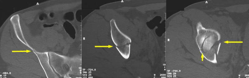Acetabular Fractures - Trauma - Orthobullets