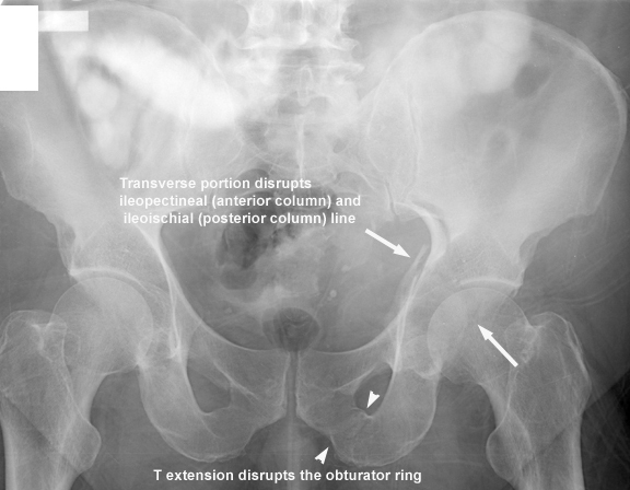 Acetabular Fractures - Trauma - Orthobullets