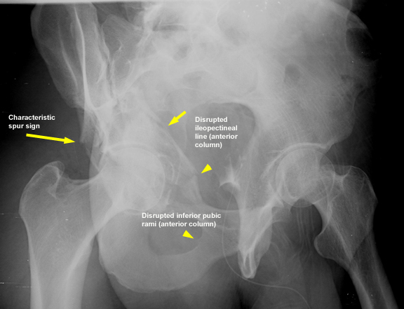Acetabular Fractures - Trauma - Orthobullets