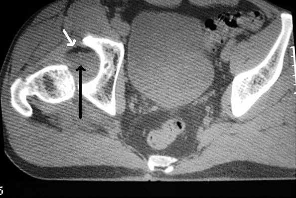 Hip Dislocation - Trauma - Orthobullets