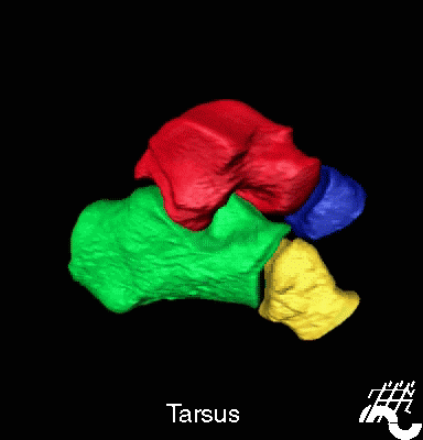 Talar Neck Fractures - Trauma - Orthobullets