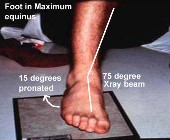 Talar Neck Fractures - Trauma - Orthobullets