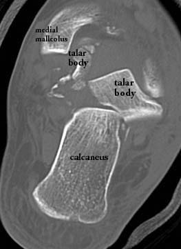 Talus Fracture (other than neck) - Trauma - Orthobullets