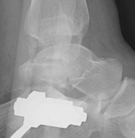 Talus Fracture (other than neck) - Trauma - Orthobullets