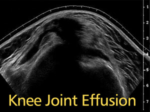 Septic Arthritis - Adult - Trauma - Orthobullets